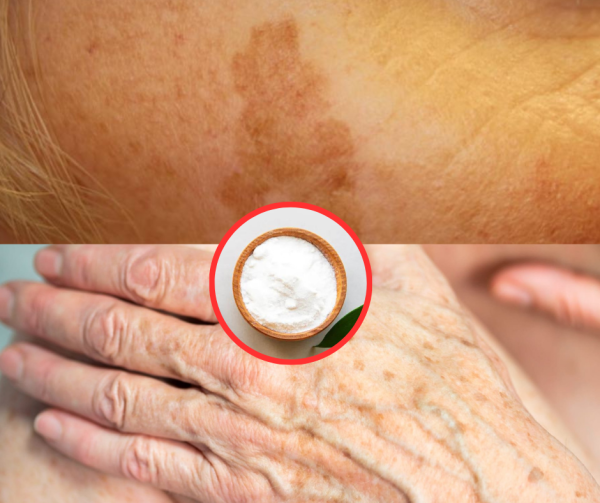 Erase Age Spots Easily with This Cheap Kitchen Ingredient: Baking Soda ...